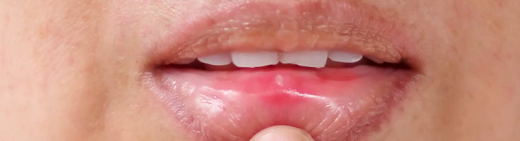 Estomatitis: ¿Qué es y cómo se trata? | Tot Dental